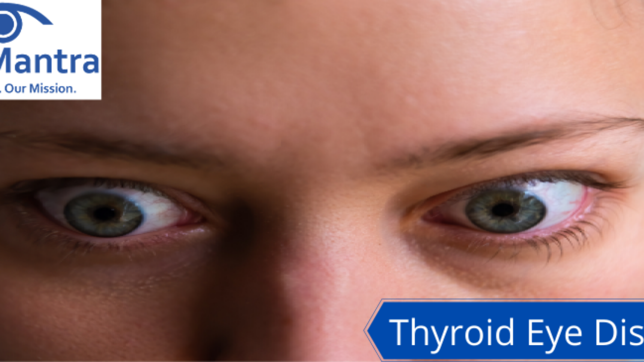 Update On Thyroid Eye Disease New Treatment For Thyroid Eye Disease