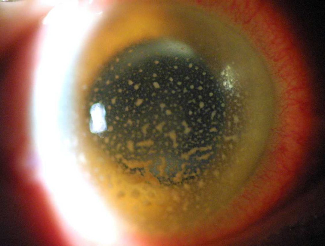 Eye Discharge and Associated Eye Problem | Eyemantra