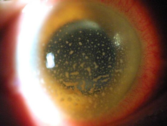 Eye Discharge and Associated Eye Problem | Eyemantra