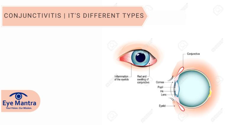 conjunctivitis | Is Pink Eye Contagious? | Eyemantra Hospital