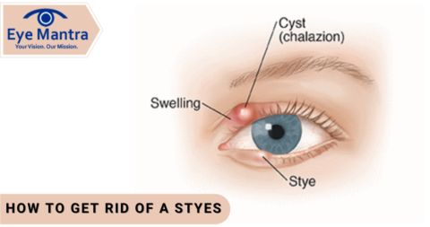 How to Get Rid of Eye Styes | Eye Styes Treatment | Eyemantra Hospital