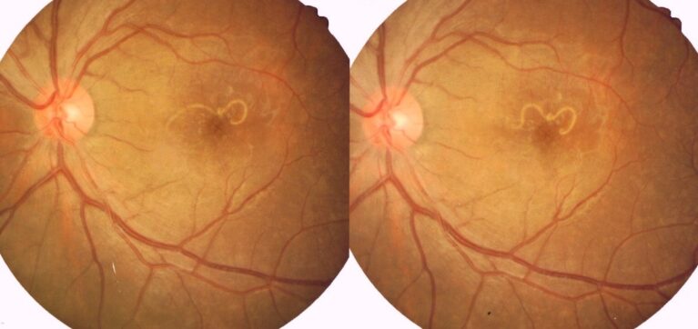 Parasites Behind The Eye Atlas Entry Ocular Toxoplasmosis