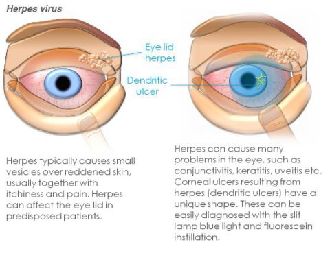 Corneal Ulcer: Symptoms, Causes, And Treatment | EyeMantra