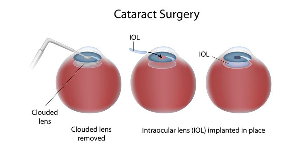 Cataract Surgery Risk And Treatment | Cataract Complications