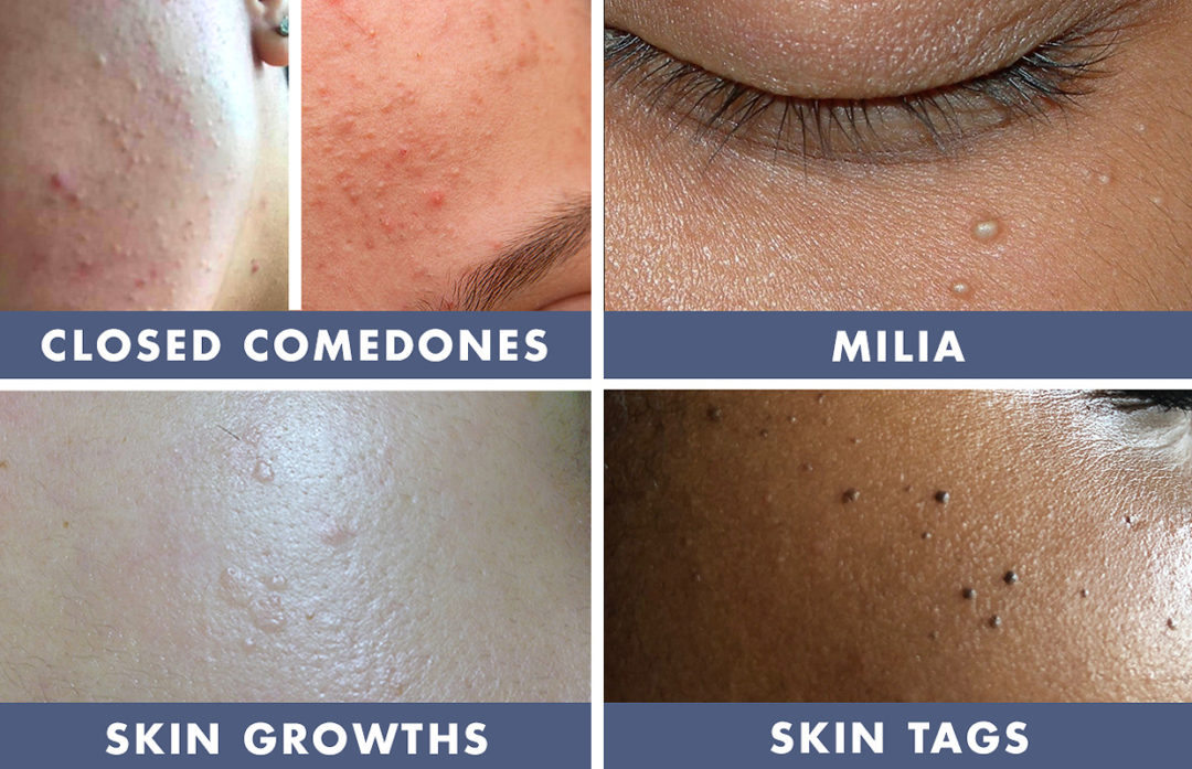 Milia Bumps on Eyelids- Types, Causes, Home Remedies [2026]