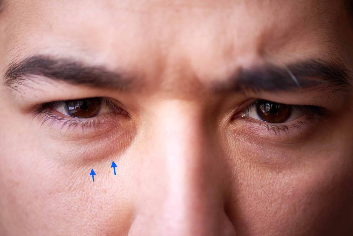 How To Get Rid of Bags Under Your Eyes? Naturally & Fast!