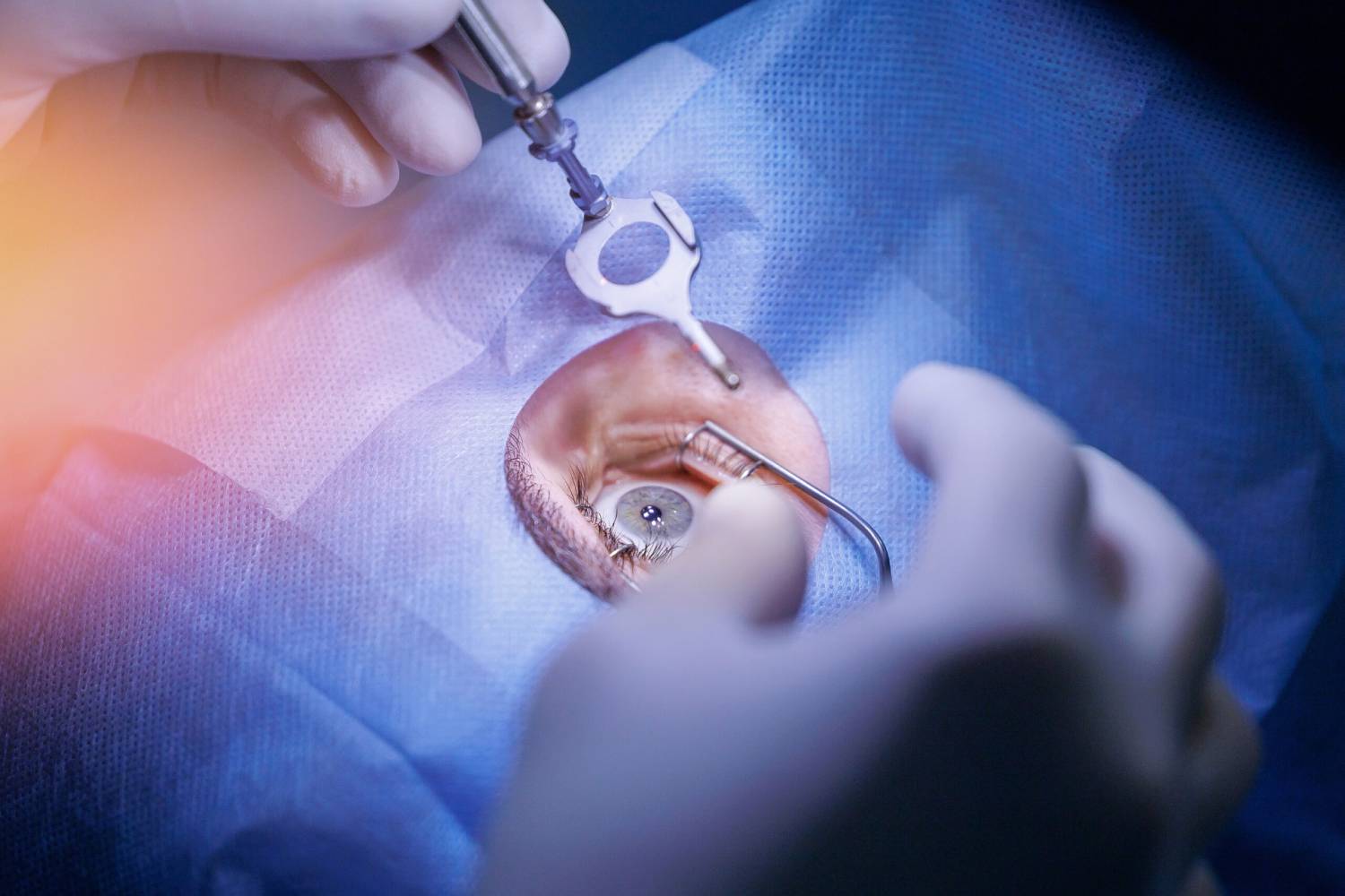 Latest Specs Removal Surgery Options in 2026